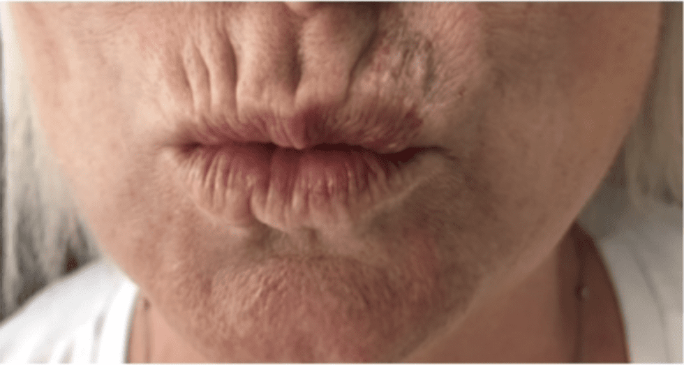 Smokers Lines Filler | Cotswold & County Aesthetics