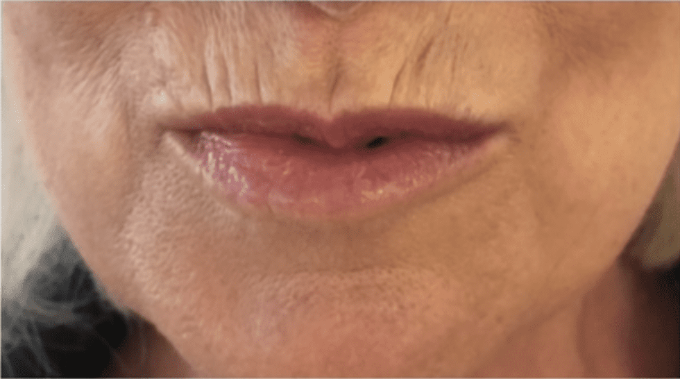 Smokers Lines Filler | Cotswold & County Aesthetics